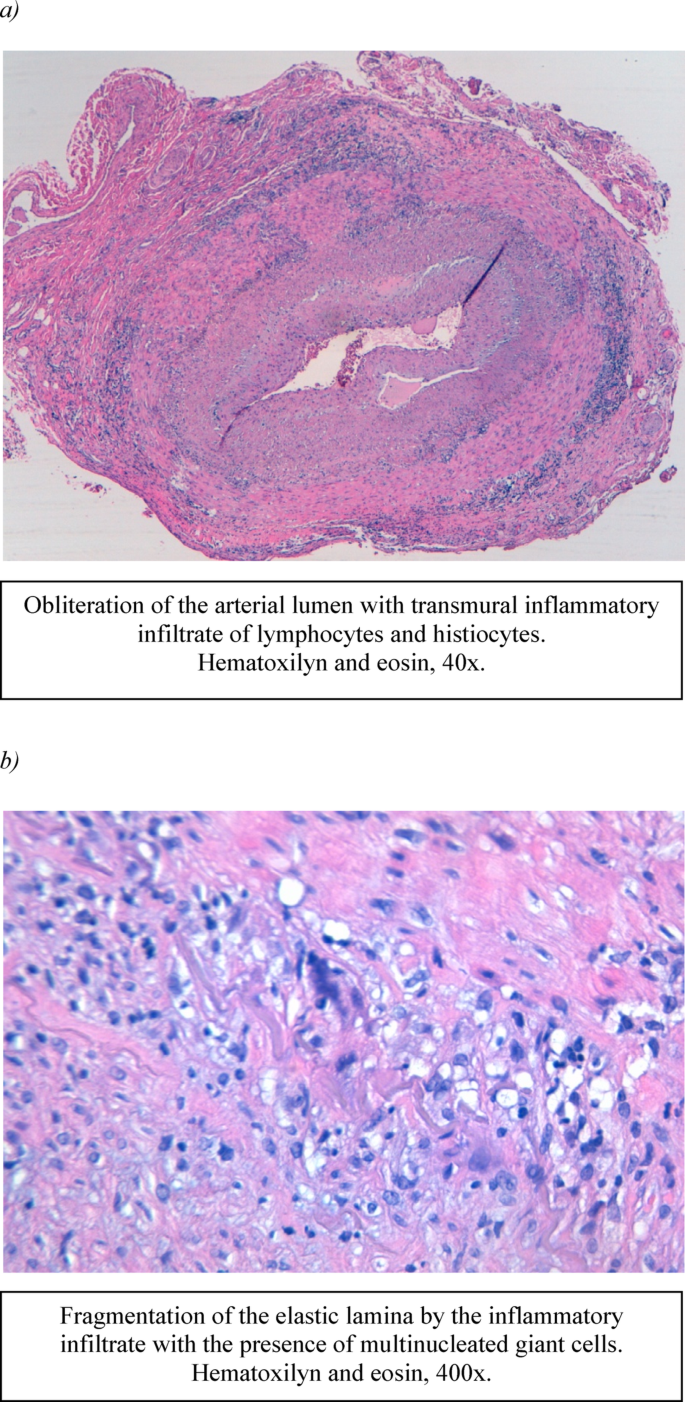 Lingual necrosis in giant-cell arteritis: a case-based review ...