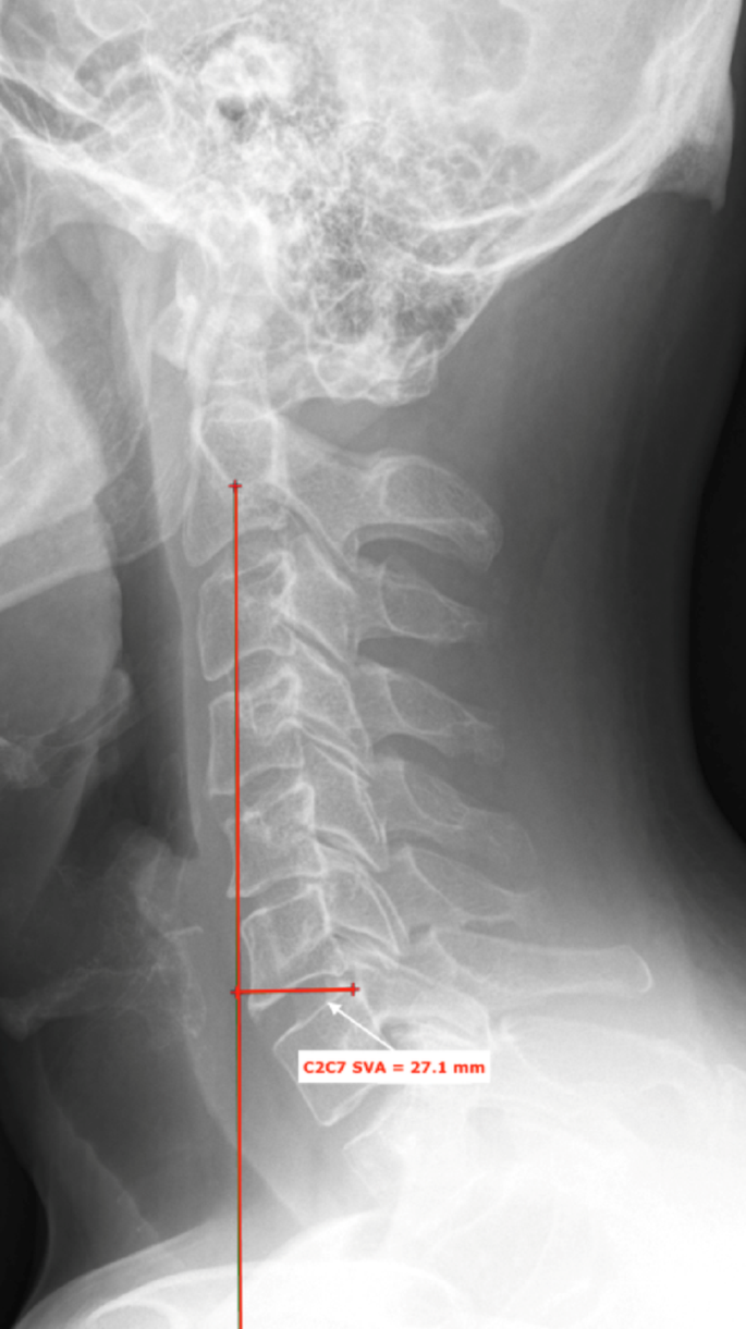 Instability in the distal-to-stabilization segments after occipito ...
