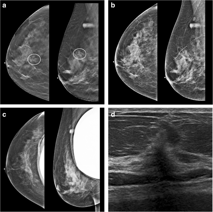 Breast cancer screening in women with and without implants ...