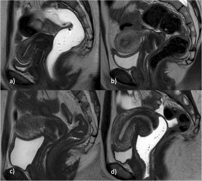 Diagnostic MRI for deep pelvic endometriosis: towards a standardized ...