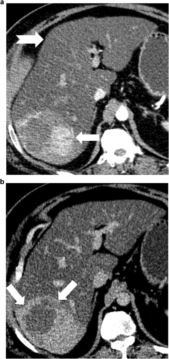 Diagnostic performance of CT/MRI LI-RADS v2018 in non-cirrhotic ...