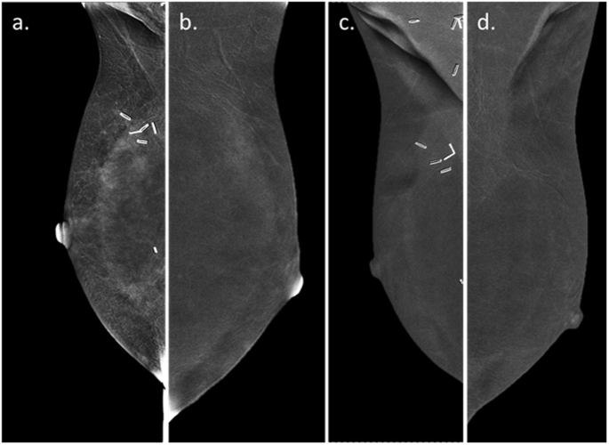 Asymmetric background parenchymal enhancement on contrast-enhanced ...