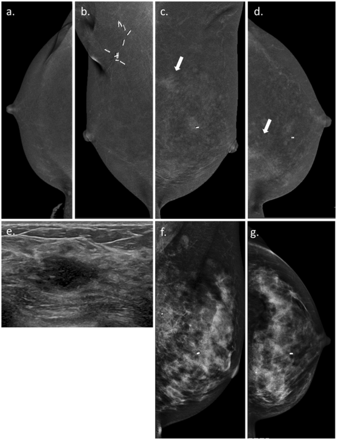 Asymmetric background parenchymal enhancement on contrast-enhanced ...
