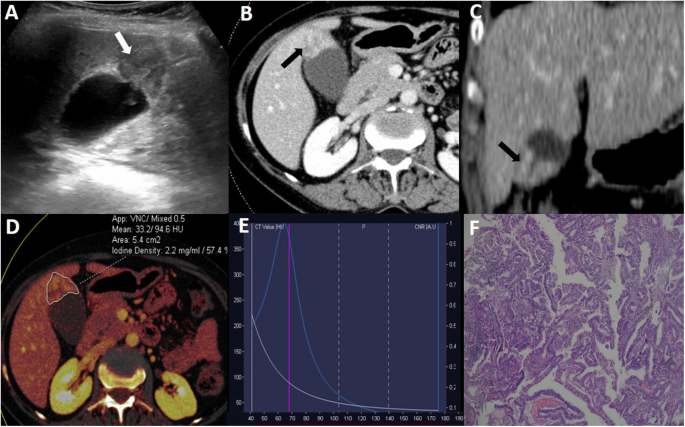 Dual-energy CT in differentiating benign gallbladder wall thickening ...