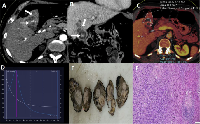 Dual-energy CT in differentiating benign gallbladder wall thickening ...