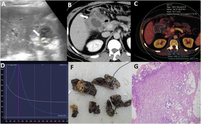 Dual-energy CT in differentiating benign gallbladder wall thickening ...