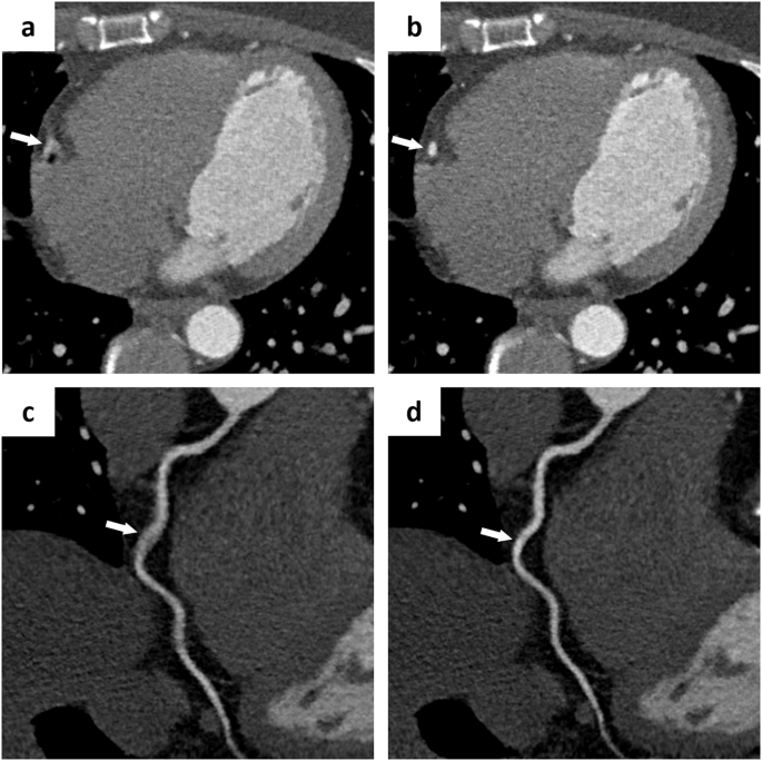 Optimizing coronary CT angiography quality with motion-compensated ...