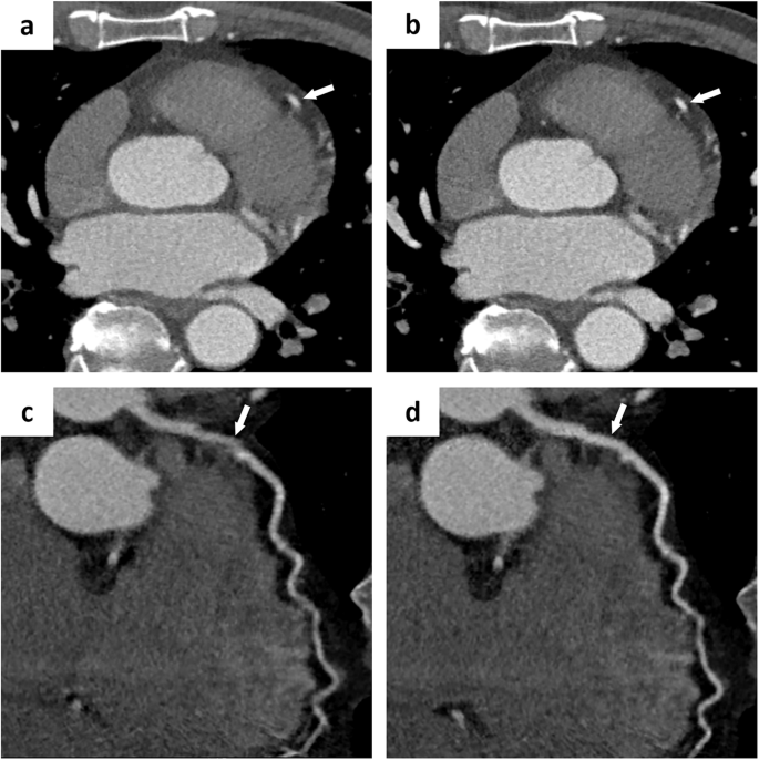 Optimizing coronary CT angiography quality with motion-compensated ...