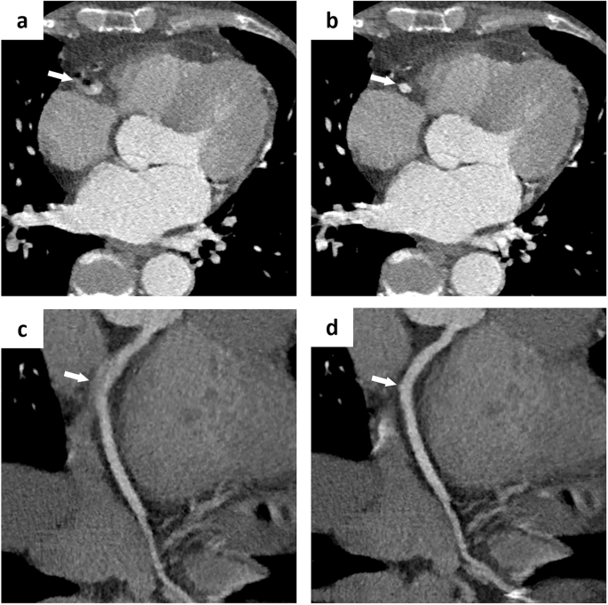 Optimizing coronary CT angiography quality with motion-compensated ...