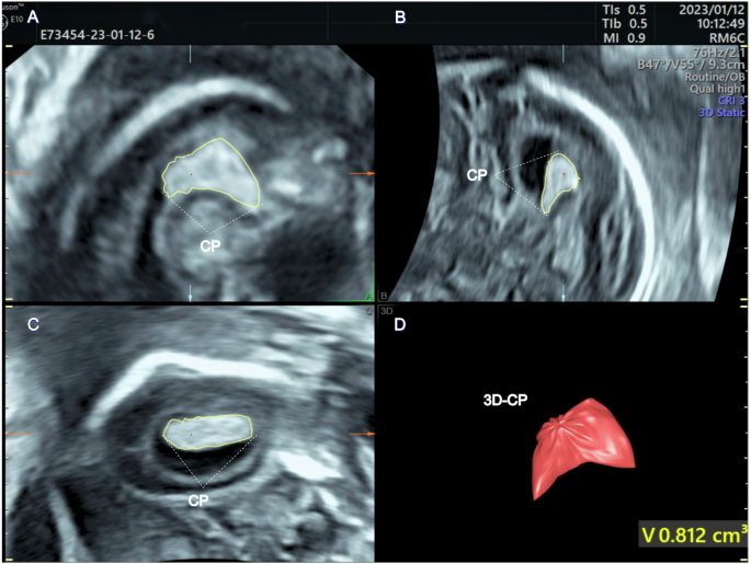 Is choroid plexus growth altered in isolated ventriculomegaly on fetal ...