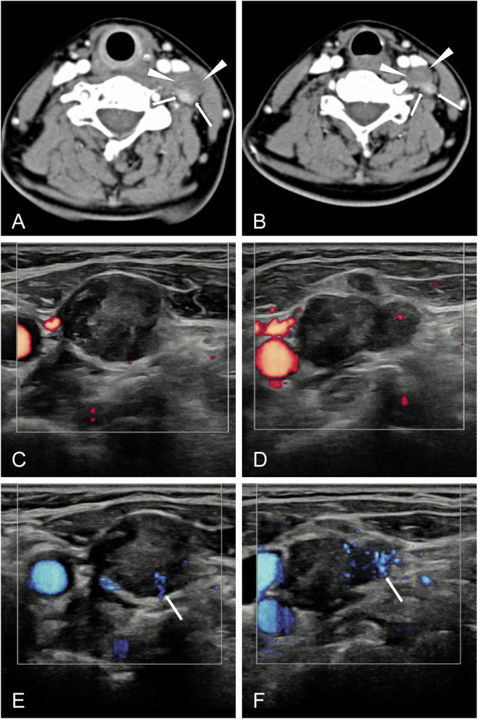 Effectiveness of microvascular flow imaging for radiofrequency ablation ...
