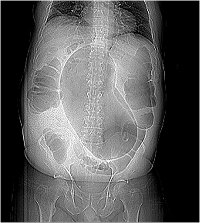 Sigmoid volvulus—Can CT features predict outcomes and recurrence ...