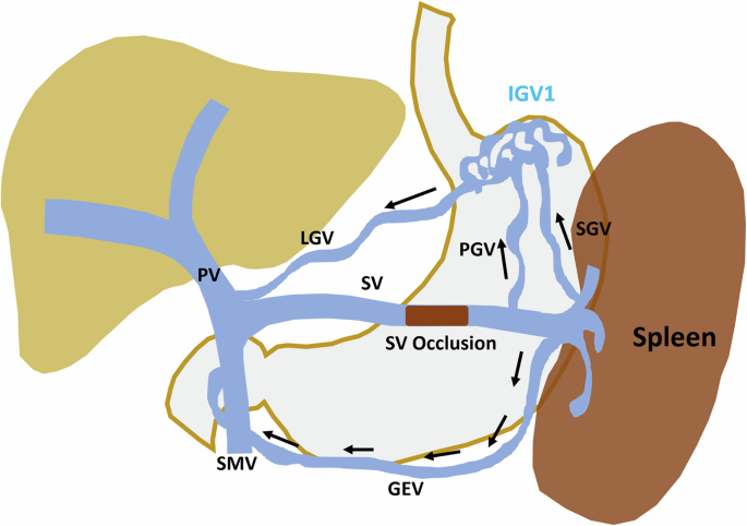 Left-sided portal hypertension: what an interventional radiologist can offer? | European Radiology