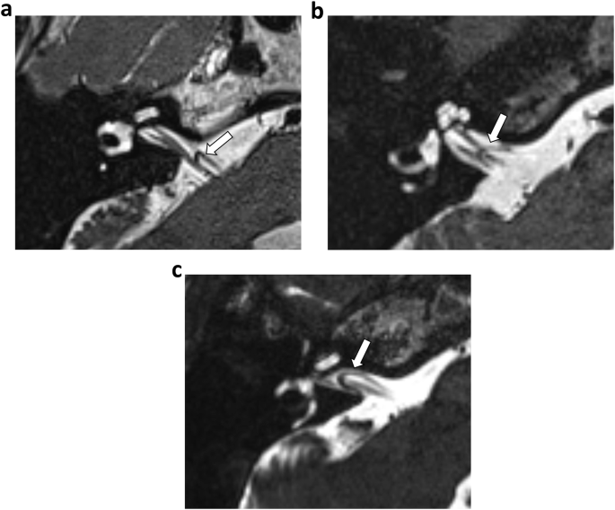 Internal auditory meatus vascular loops and vestibulocochlear ...
