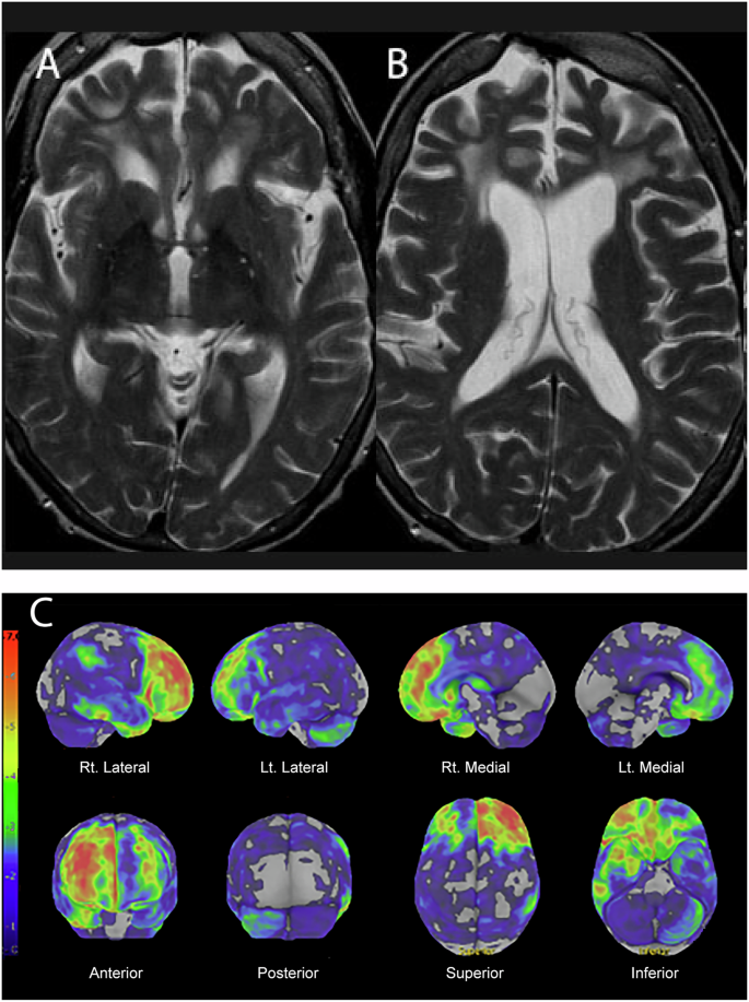 The role of brain MR and FDG-PET in the diagnosis of neurodegenerative ...