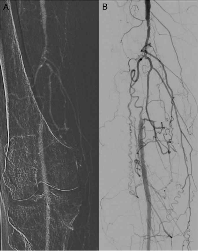 Safety and evidence of CO2 as a vascular contrast agent as an ...