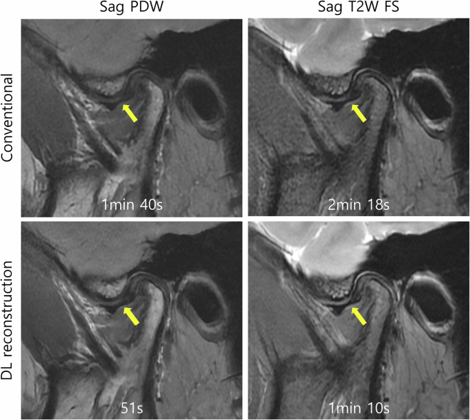 Deep learning reconstruction for temporomandibular joint MRI ...