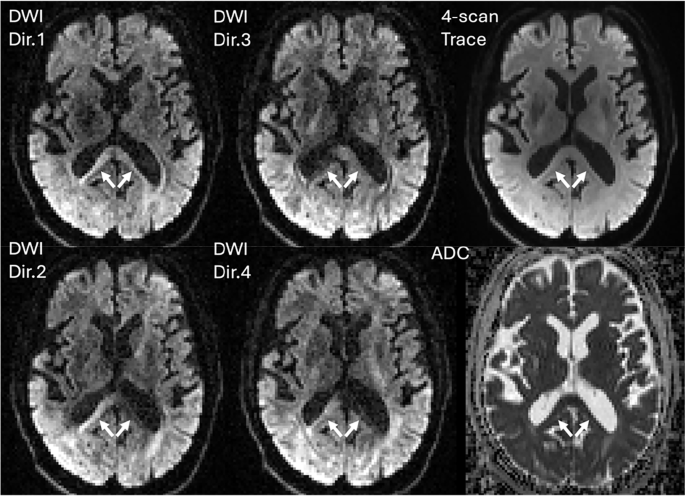 ESR Essentials: diffusion-weighted MRI—practice recommendations by the ...