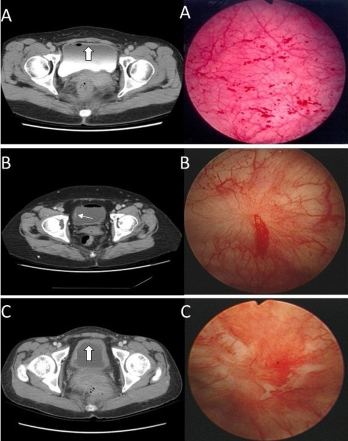 Focal or diffuse bladder wall thickness on bladder computed tomography ...