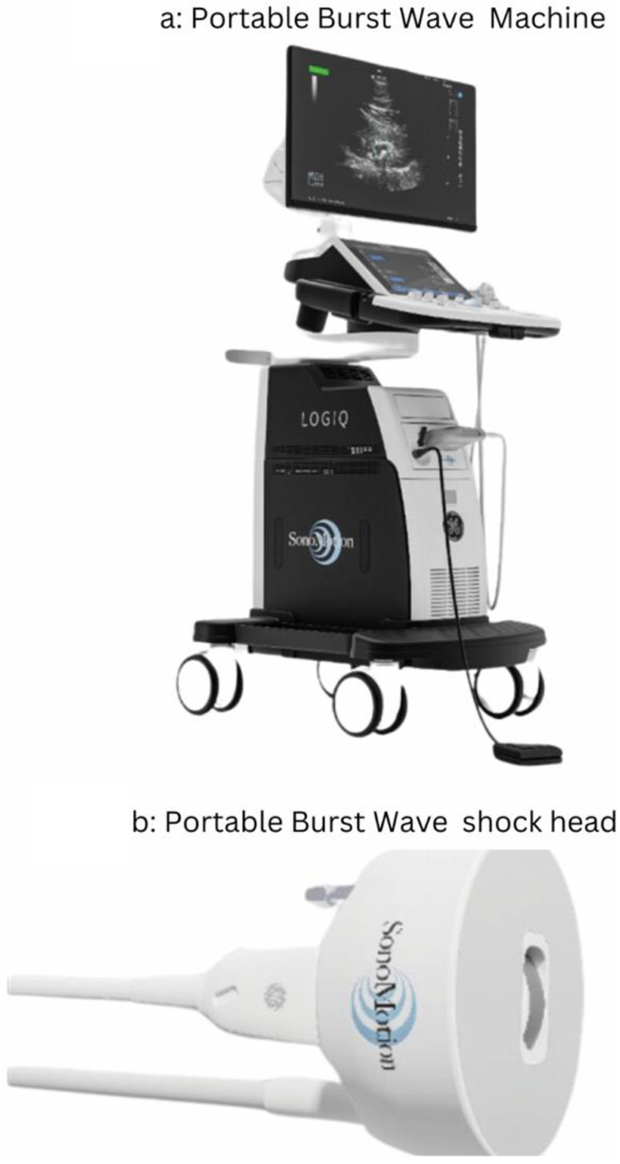 Burst wave lithotripsy - a paradigm shift: inferences from a scoping ...
