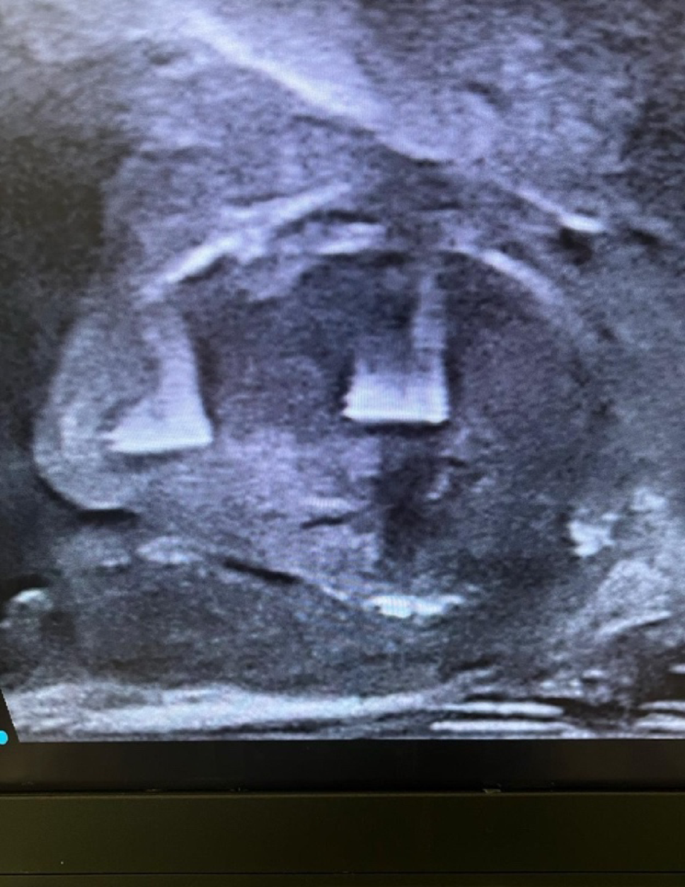 Efficacy, feasibility, and safety of aquablation after previous urolift ...