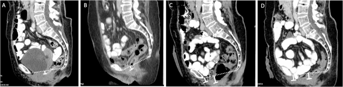 Characterizing pelvic organ descent in women after radical cystectomy ...