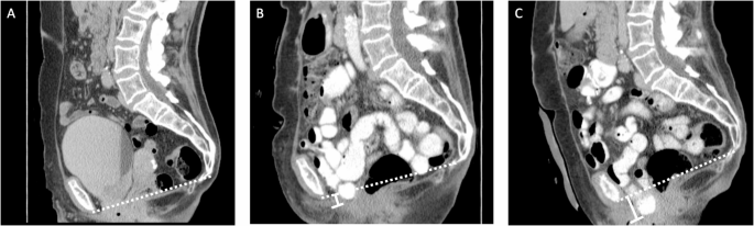 Characterizing pelvic organ descent in women after radical cystectomy ...