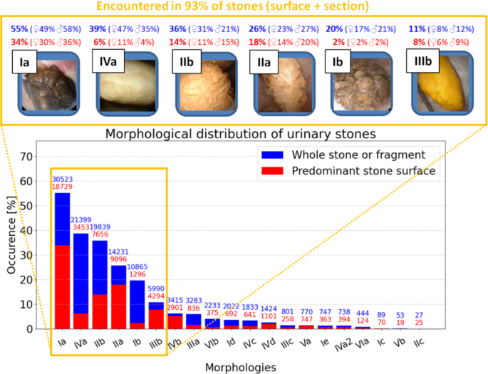 Comprehensive analysis of 55,213 stones: understanding common ...