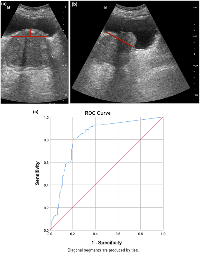 Intravesical prostatic protrusion volume: effect on lower urinary tract ...