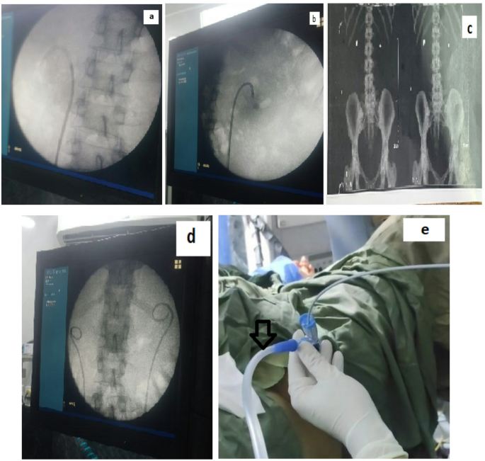 Efficacy and safety of bilateral same session flexible ureteroscopy ...