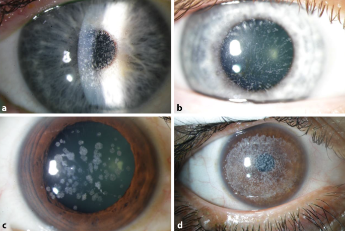 Die aktuelle IC3D-Klassifikation der Hornhautdystrophien – Übersicht ...