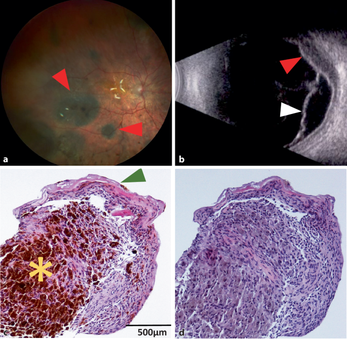 Bilaterale diffuse uveale melanozytäre Proliferation (BDUMP) als ...