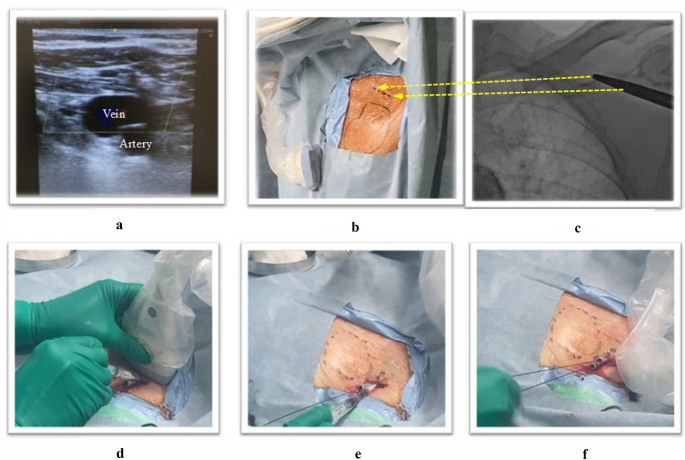 Comparative analysis of ultrasound-guided versus fluoroscopy-guided ...