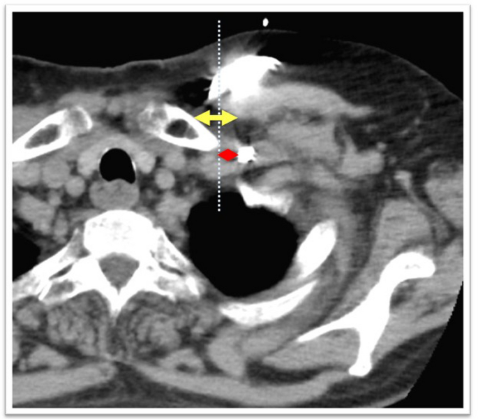 Comparative analysis of ultrasound-guided versus fluoroscopy-guided ...