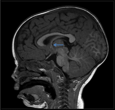 The foramen of Monro: a review of its anatomy, history, pathology, and ...