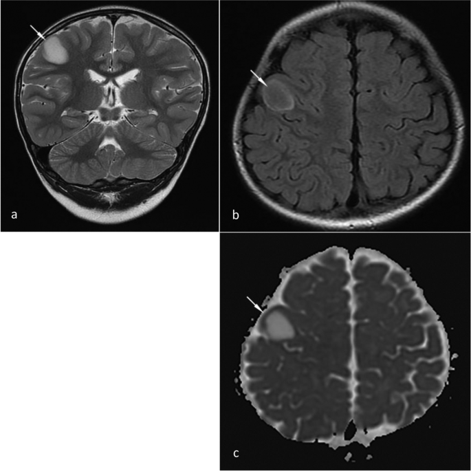 Pediatric-type diffuse low-grade glioma with T2-FLAIR mismatch sign: a ...