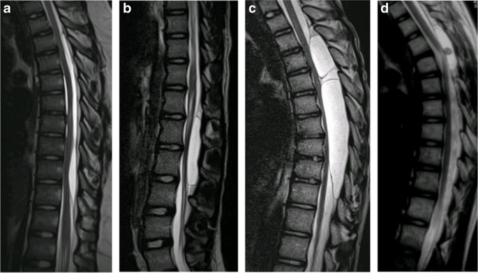 Pediatric spinal arachnoid cysts with compressive myelopathy: single ...