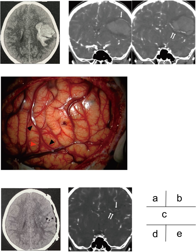Atypical venous drainage system and distinct vascular characteristics ...