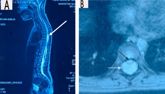 Intradural extramedullary neurenteric cyst: a case report | Child's ...