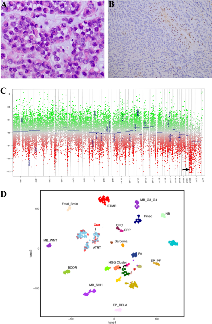 Primary diffuse leptomeningeal atypical teratoid/rhabdoid tumours (ATRT ...