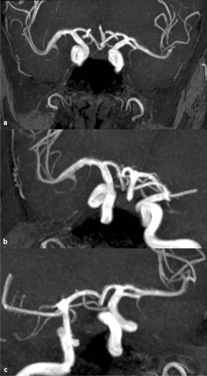 Neuroimaging of middle cerebral artery anomalies: a report of three ...