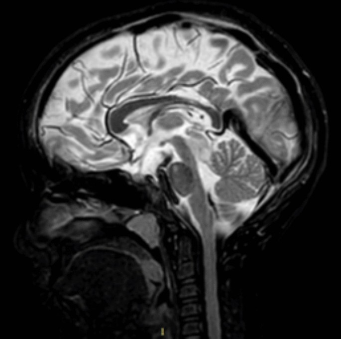 Aqueductal glioma surgery via a telovelar approach using sodium ...