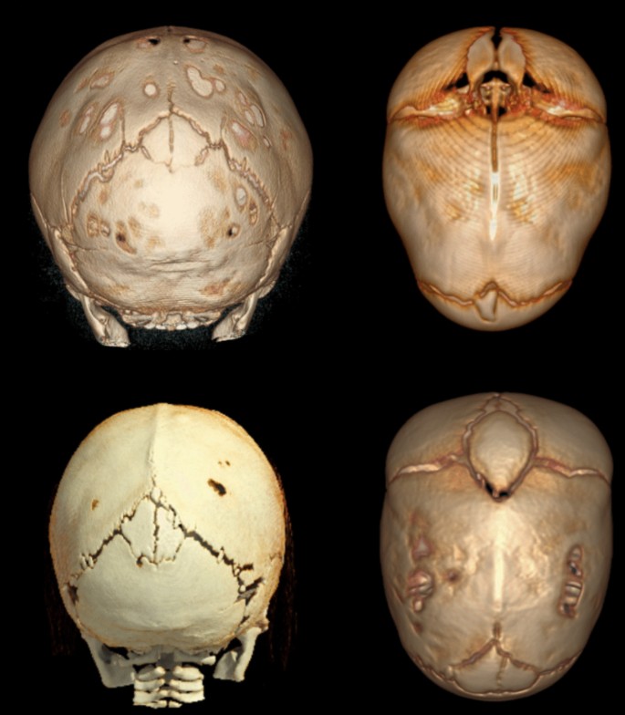 Wormian bones in simple sagittal synostosis: incidence and correlations ...
