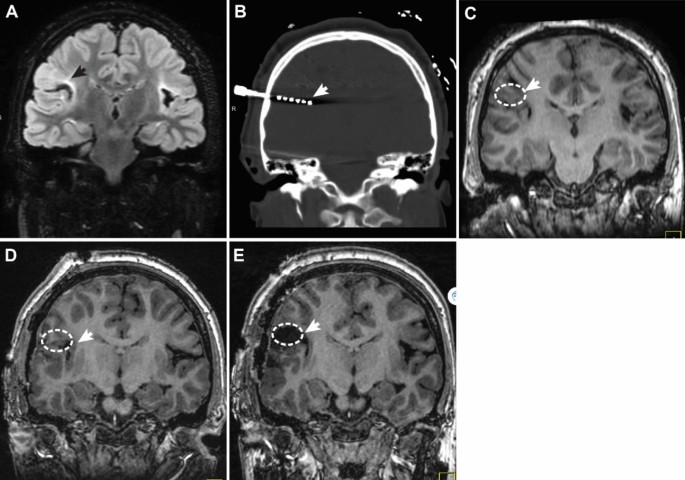 Intraoperative magnetic resonance imaging during surgical resection for ...
