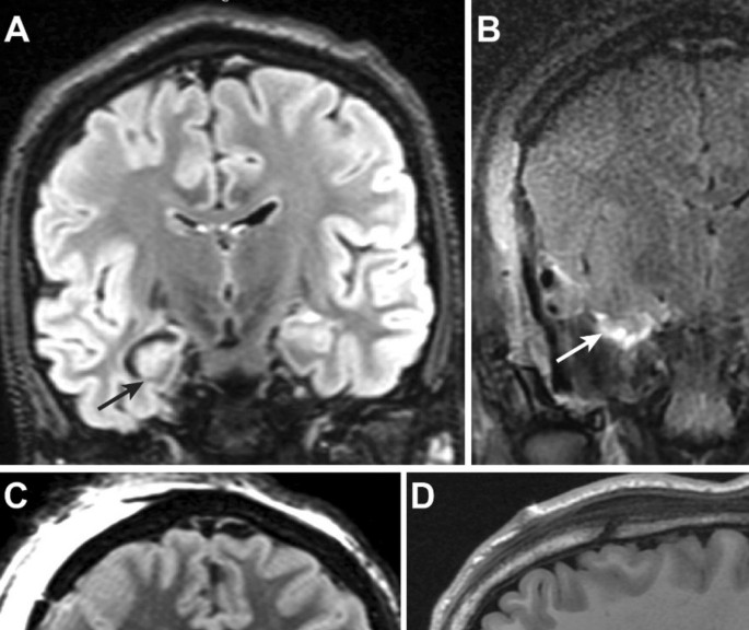 Intraoperative magnetic resonance imaging during surgical resection for ...
