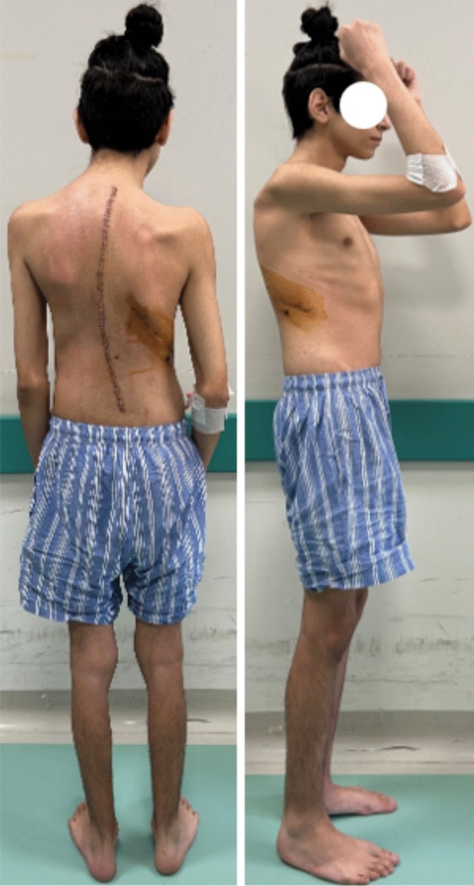A case of severe idiopathic adolescent scoliosis: the importance of a ...