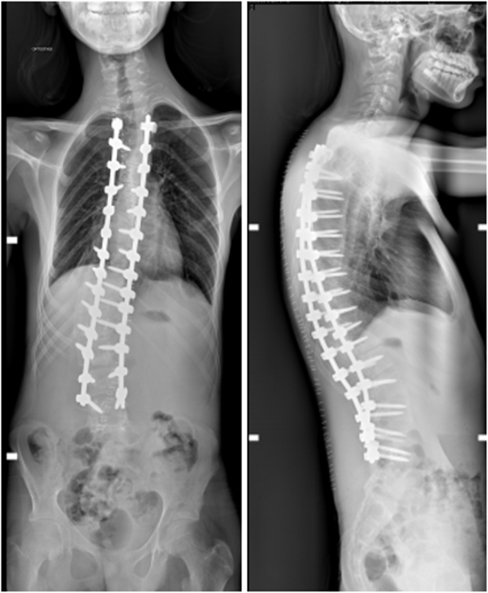 A case of severe idiopathic adolescent scoliosis: the importance of a ...