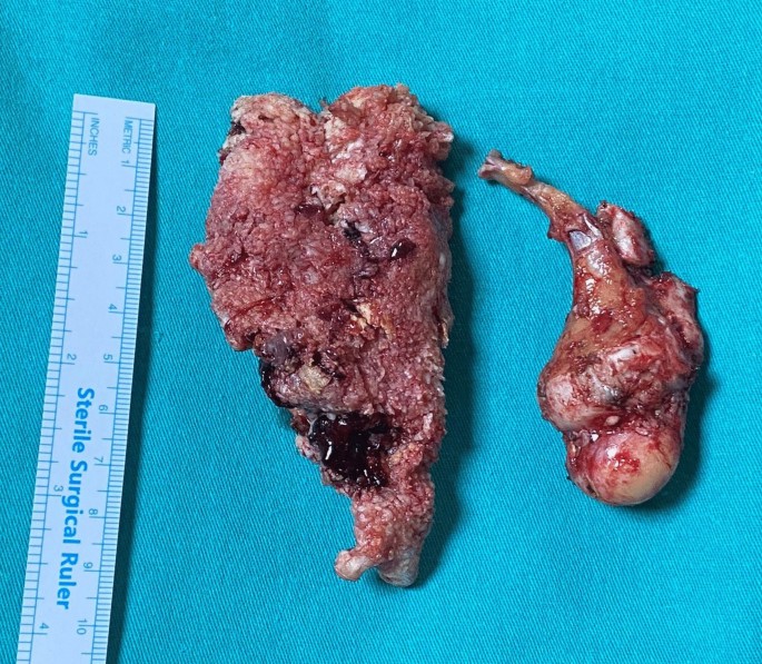 Giant intracranial teratoma in a pediatric patient: a case report and ...