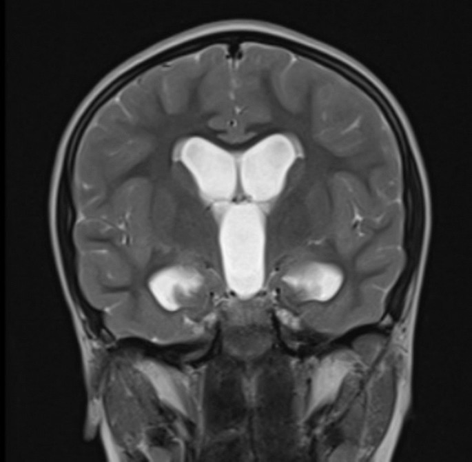 A silent intruder: arachnoid cyst of the third ventricle of the brain ...