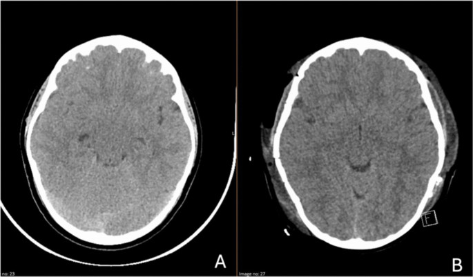 Management of secondary intracranial hypertension in untreated ...